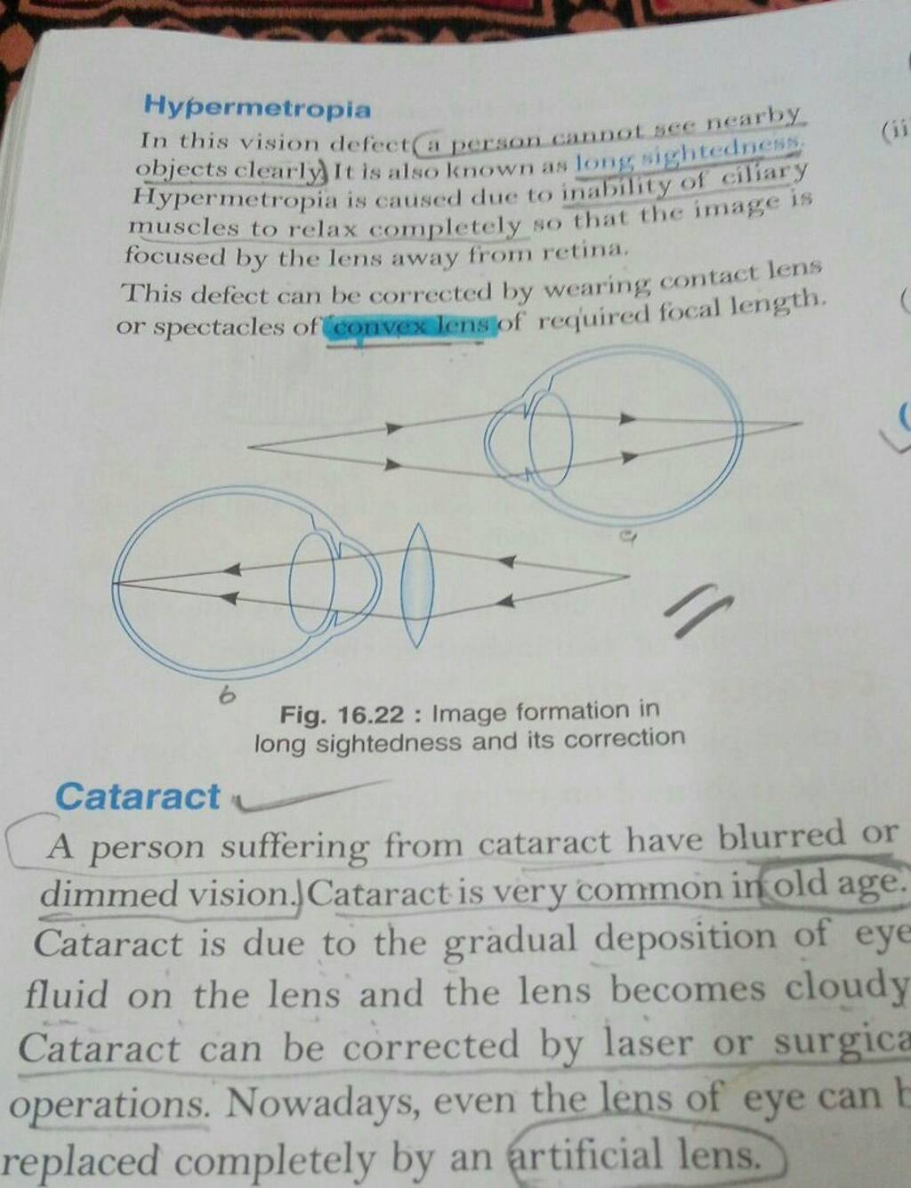 Hypermetropia In this vision defect a person cannot see nearby objects cl..
