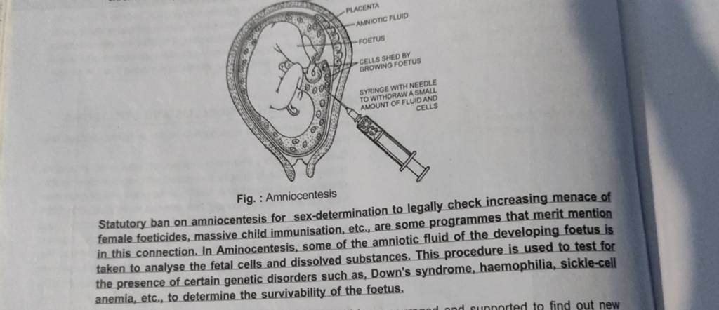 Fig. : Amniocentesis Statutory ban on amniocentesis for sex-determination..