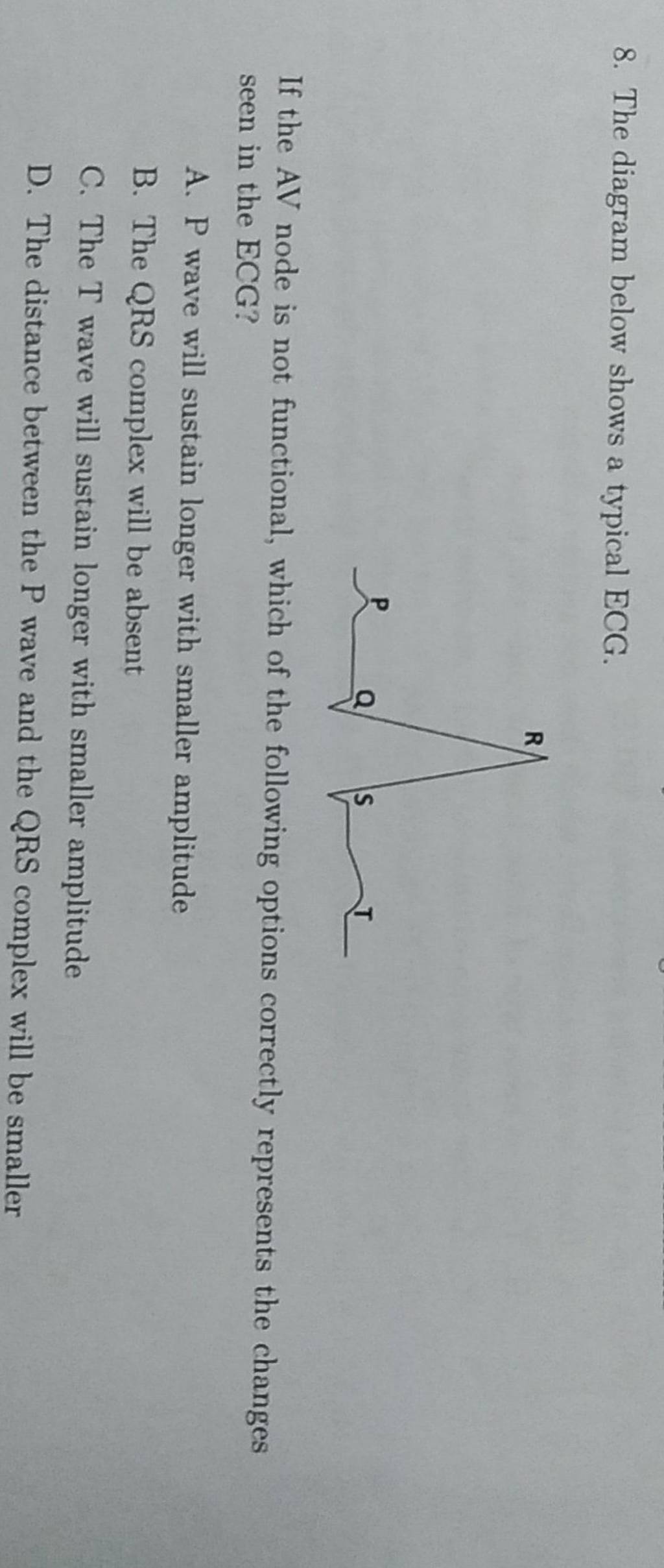 The diagram below shows a typical ECG. If the AV node is not functional,