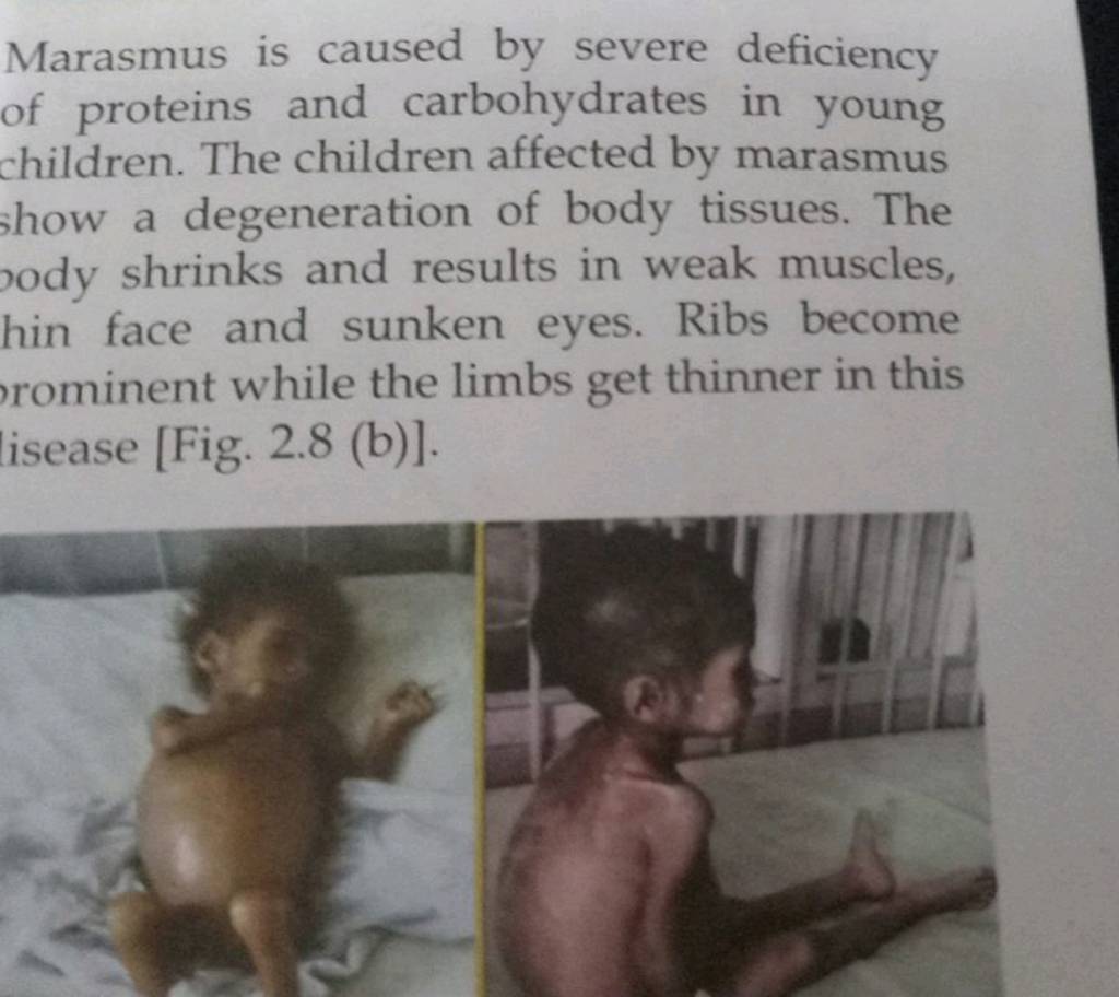 Marasmus is caused by severe deficiency of proteins and carbohydrates in